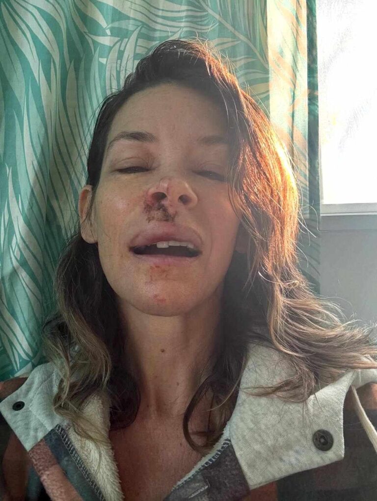 Evangeline Lilly Brain Damage: Shocking Hawaii Fall Accident Details ...